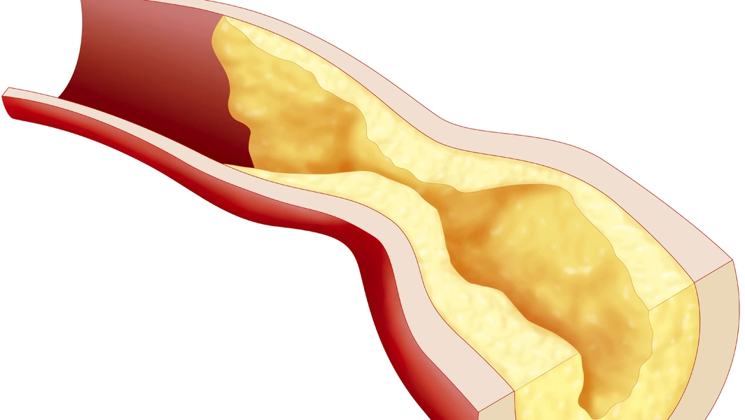 12 warning signs of high cholesterol
