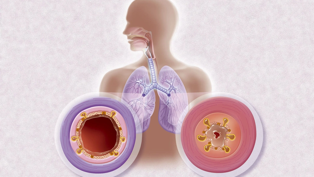 Breathing easier with bronchial health tips
