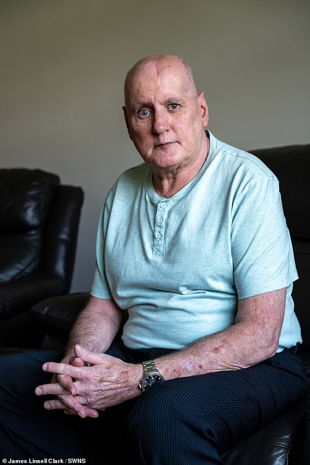 Cyclist, 66, had a quarter of his skull removed after hitting a fly ...