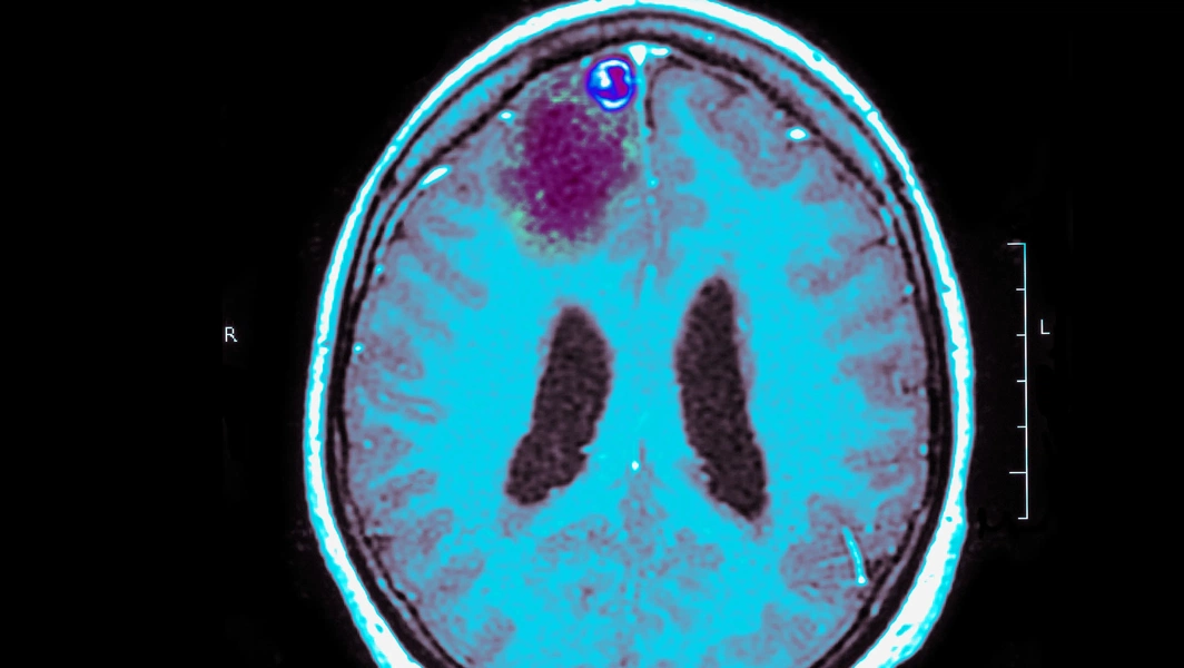Toddler’s seizure leads to rare aggressive brain cancer diagnosis