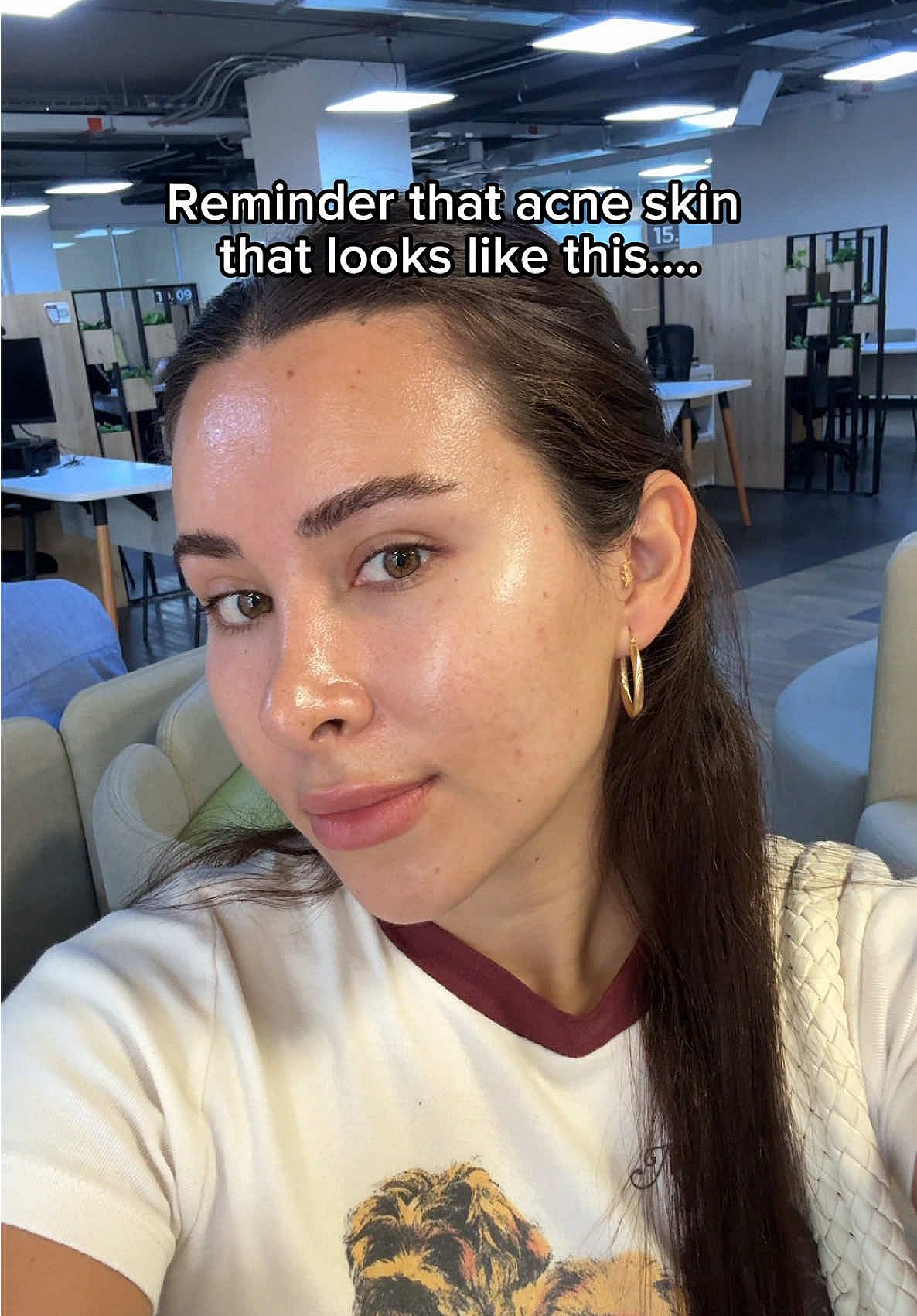 How to treat acne scars for smoother clearer skin