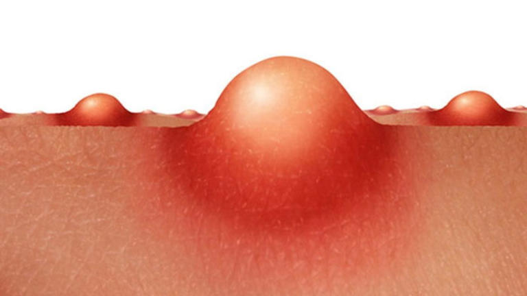 Understand vaginal acne causes, prevention and treatment options ...
