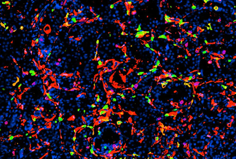 Experimental treatment directly kills prostate tumor cells while ...