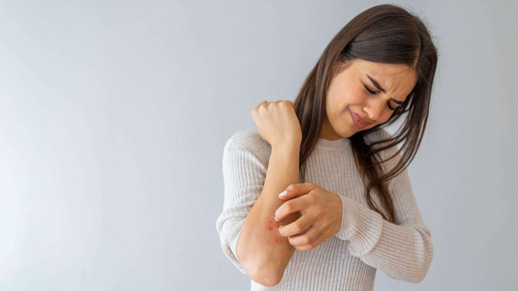 Struggling with eczema? These 5 foods could be the culprit