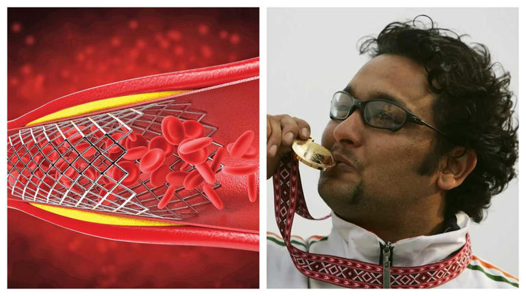 Cardiac rupture after heart attack: What shooter Jaspal Rana’s case ...