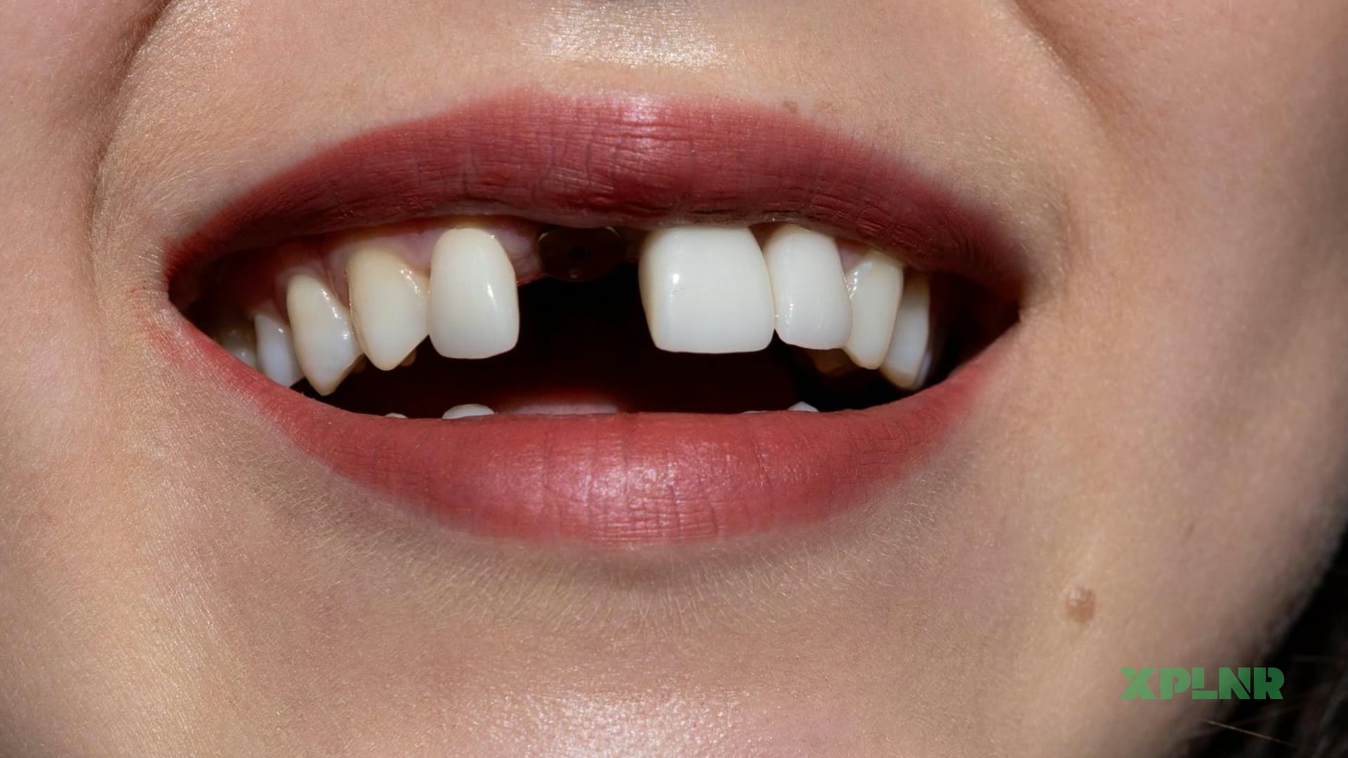 Dreaming about your teeth falling out? Here's what it actually means