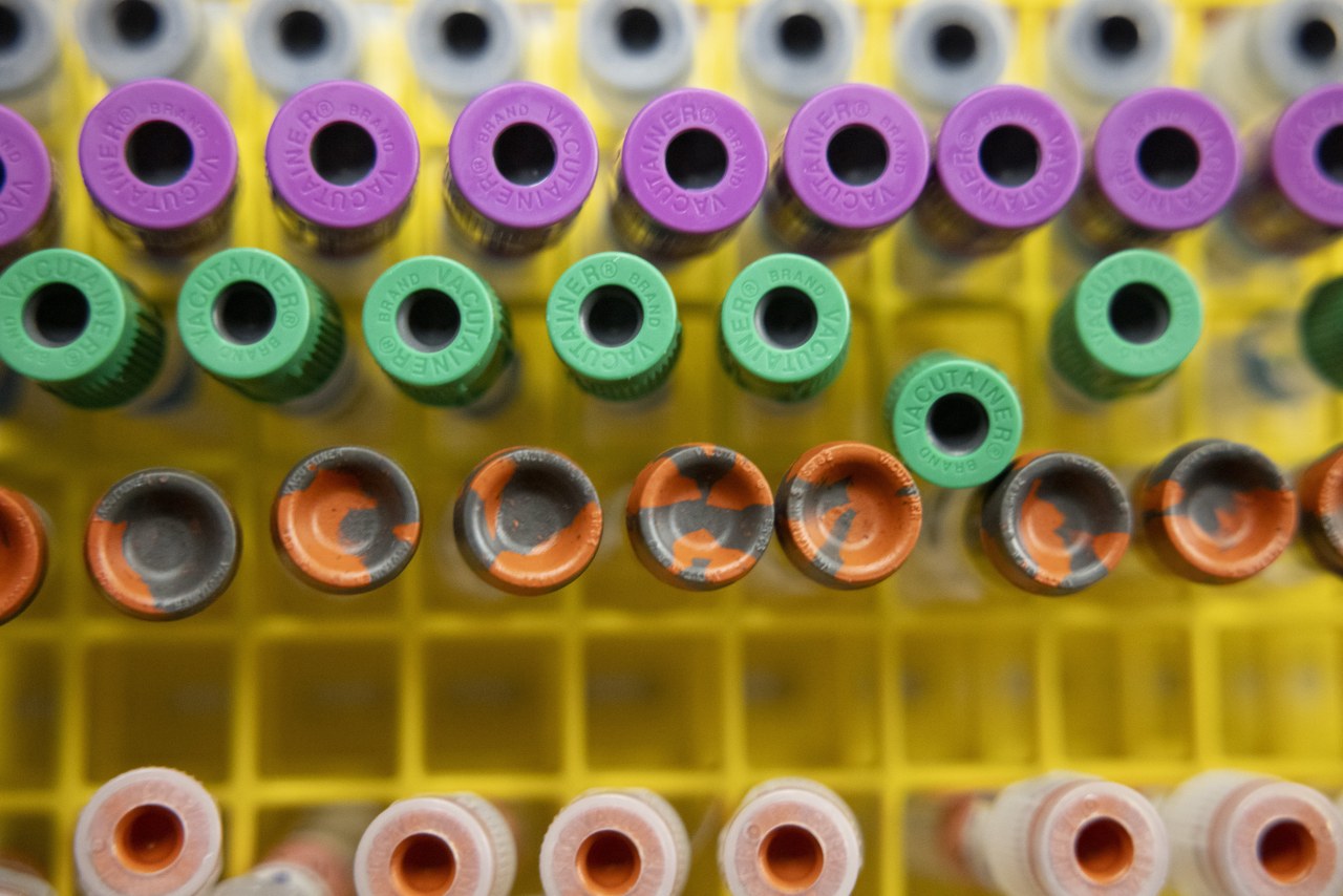 Blood tests can now detect Alzheimer’s. Should you get one?