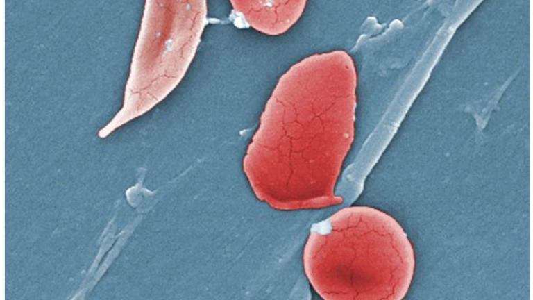 Sickle cell anaemia and pregnancy: Doctor explains the risks involved