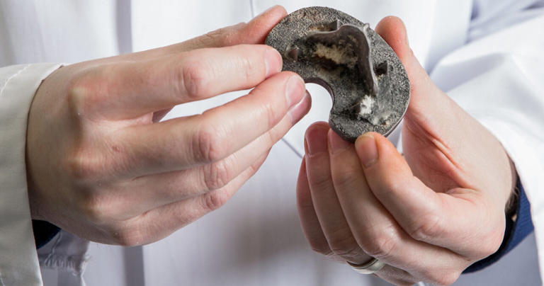 Inside failing joints: How wear and corrosion reshape hip and knee ...