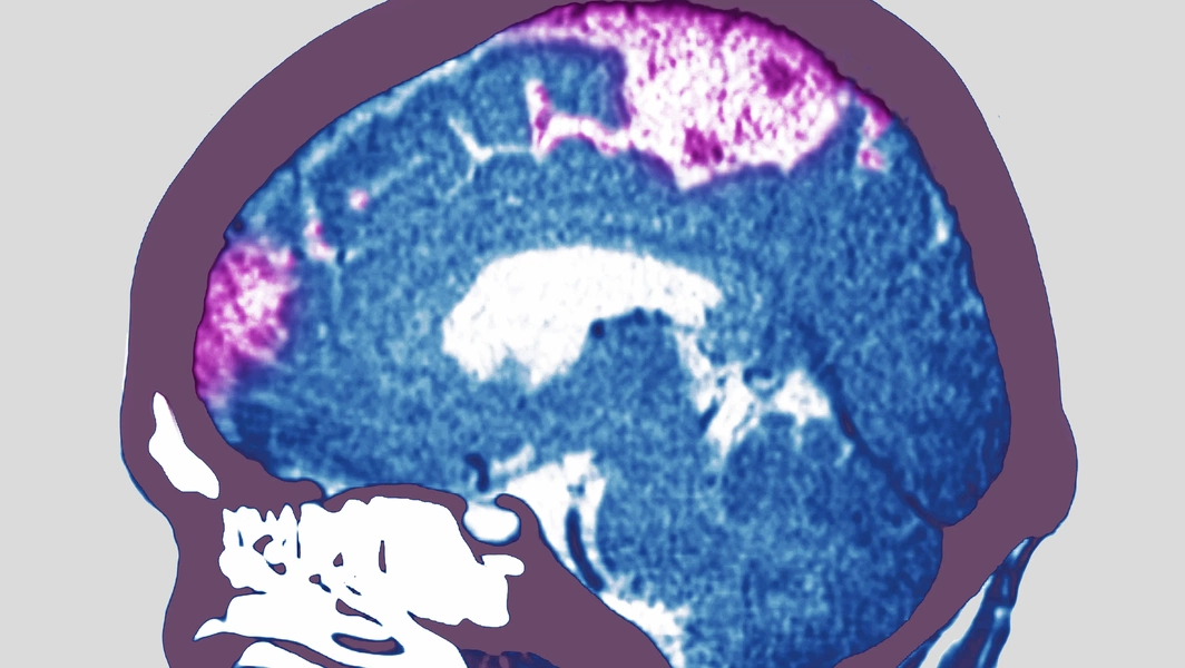 Recognizing stroke warning signs and risks