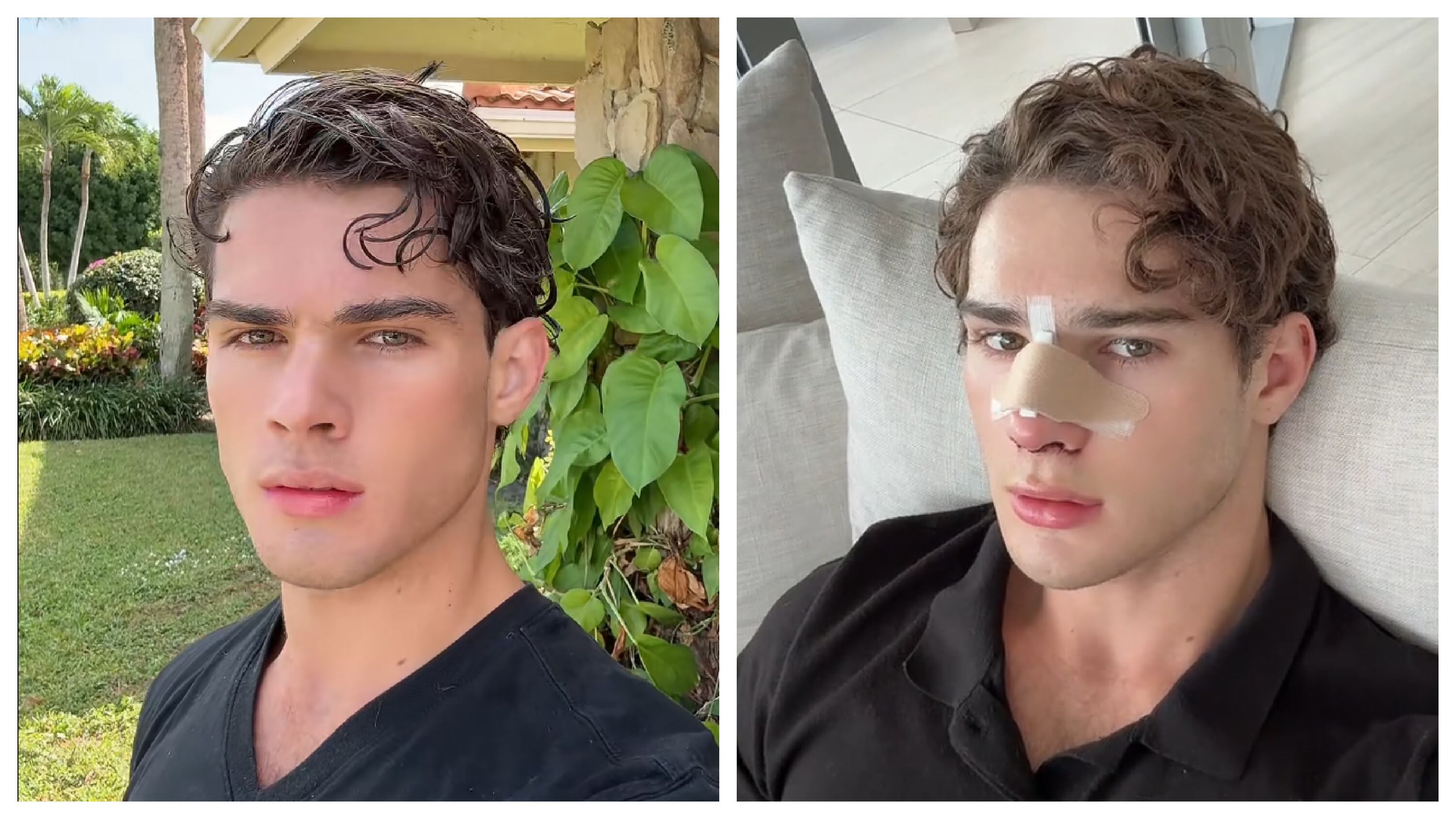 Looksmaxxing influencer Clavicular's nose job reveal draws brutal backlash