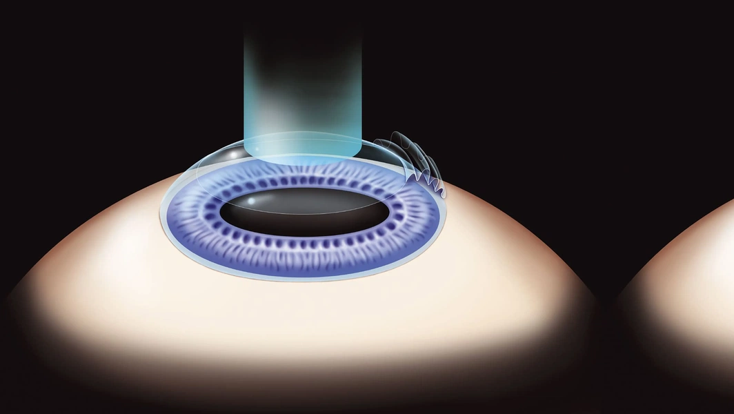 LASIK benefits and risks compared