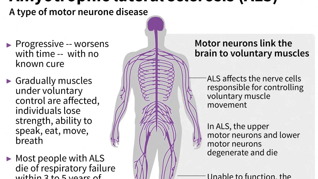 Understanding ALS: Causes, symptoms, and research
