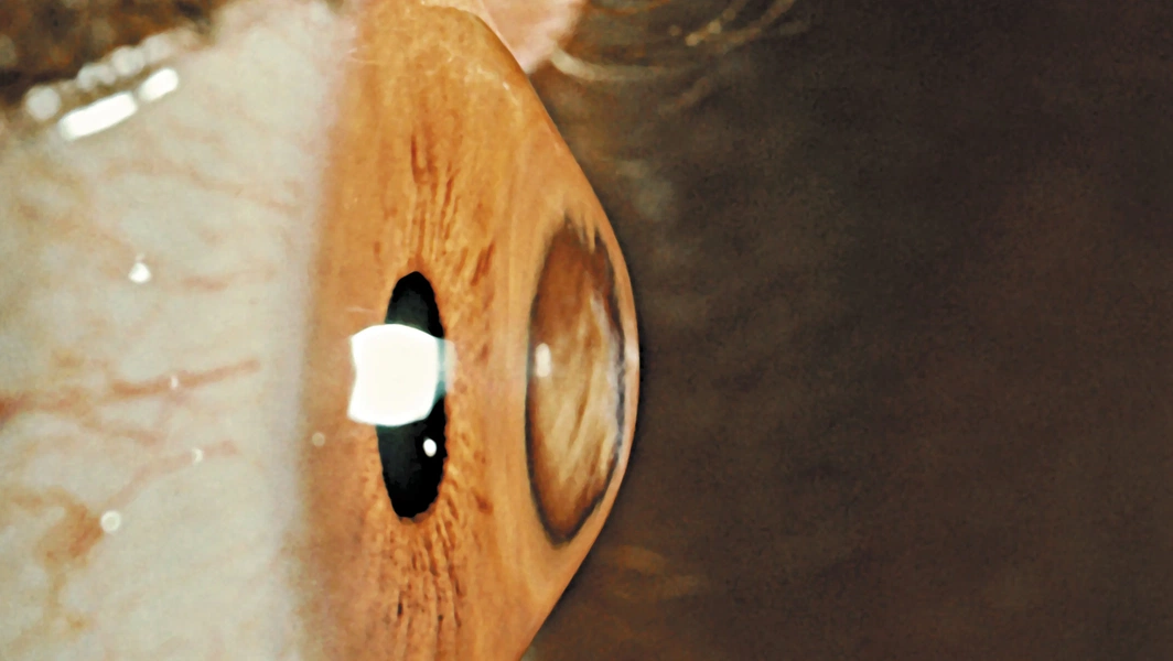 Seeing clearly with astigmatism care