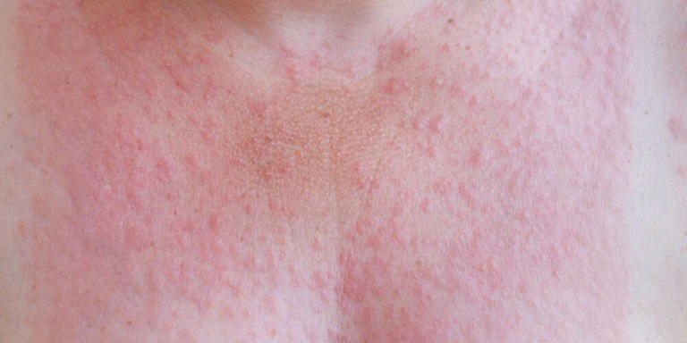 Why sun rash returns every summer – and here’s how to prevent it
