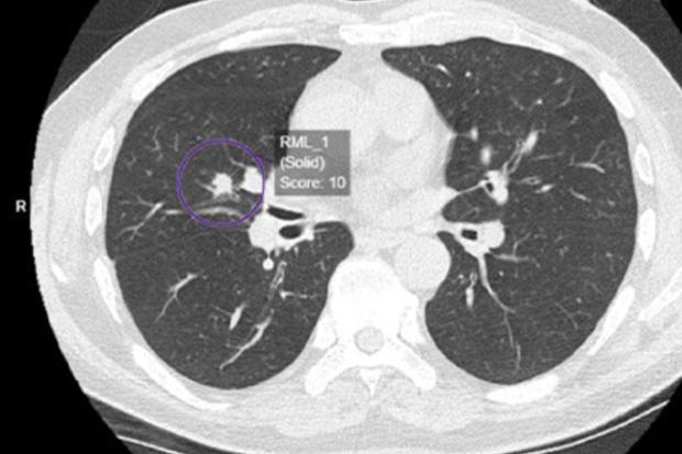 NHS Greater Glasgow and Clyde leads AI study to speed lung cancer ...