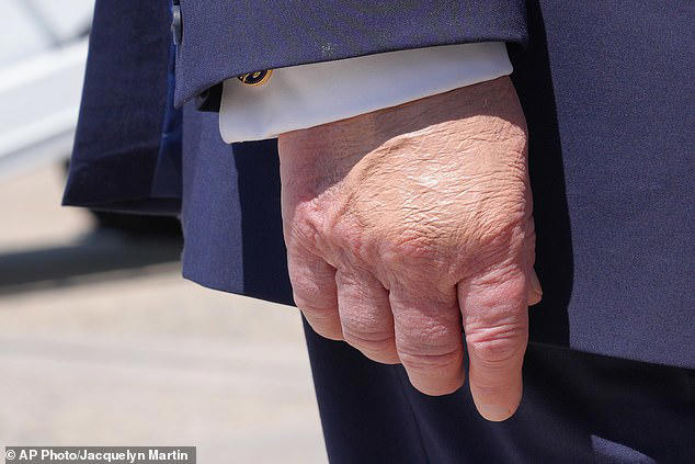 Trump spotted with unusual new mark on hand