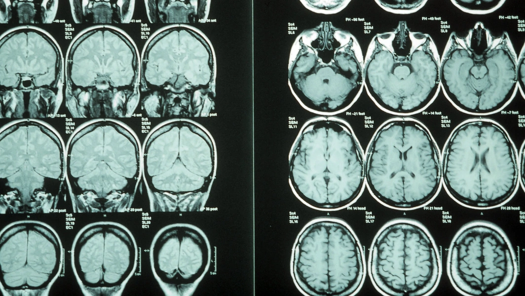 Understanding coma: Causes, effects, and recovery