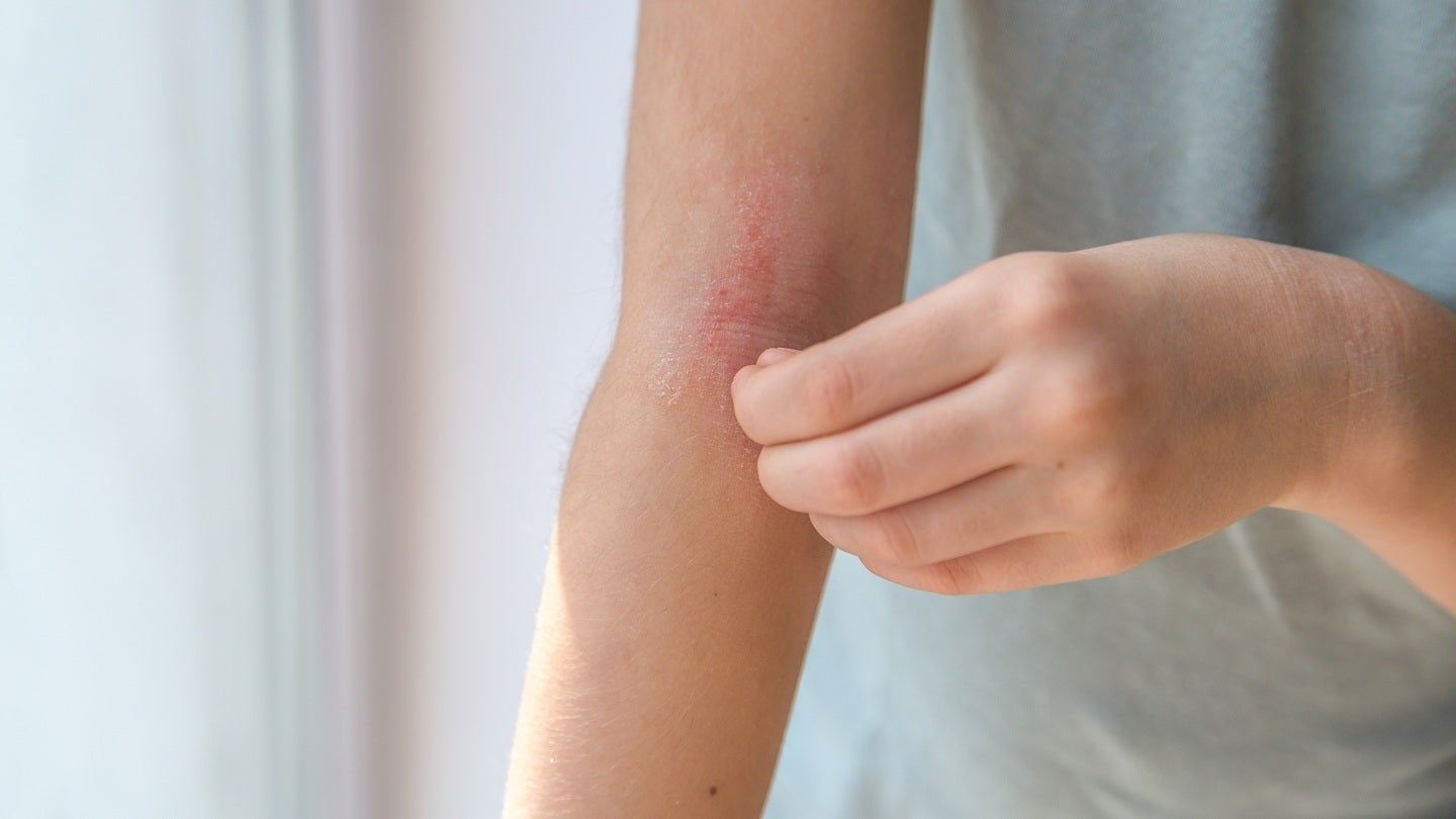 ALK’s EURneffy secures MHRA approval for anaphylaxis treatment