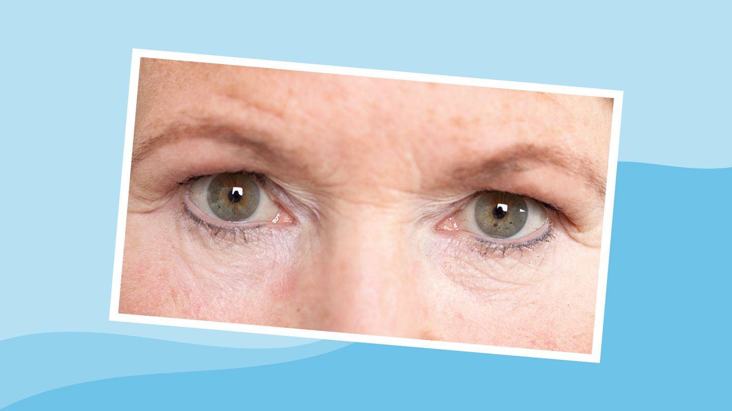 Why your eyelids get droopy as you age and what you can do about it