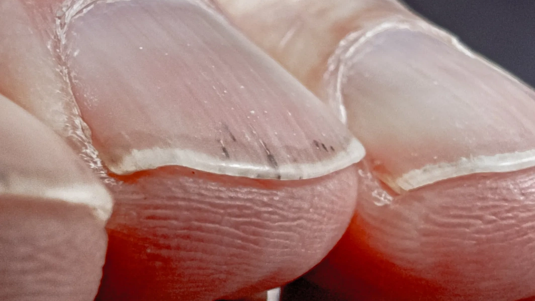Causes and care for vertical nail ridges