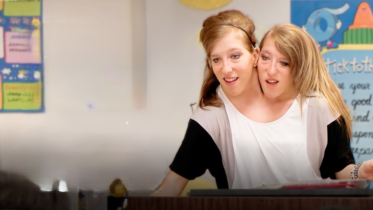 Mother gave birth to twin girls... but they shared one body