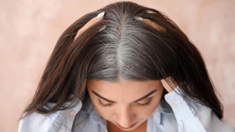 Is greying at 35 normal, and can it be reversed? A dermatologist explains