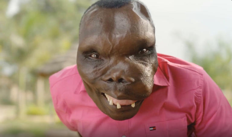 I’m the ‘world’s ugliest man’ — my rare disease turns my muscles and ...