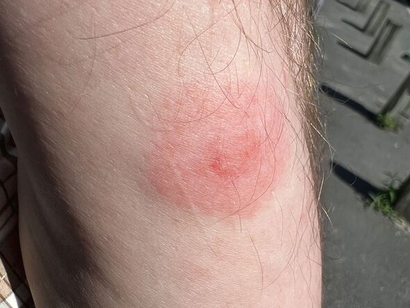 GP names nasty infection that will thrive in the UK over summer - full ...