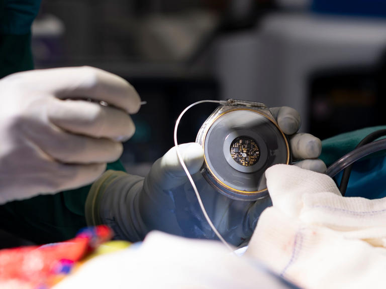 Neuralink competitor Paradromics just implanted its first brain-chip ...