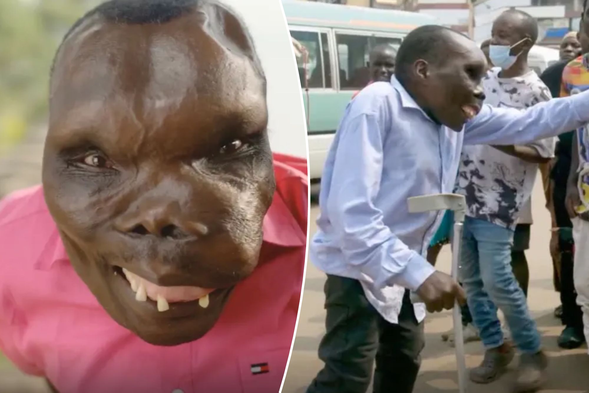 I’m the ‘world’s ugliest man’ — my rare disease turns my muscles and ...
