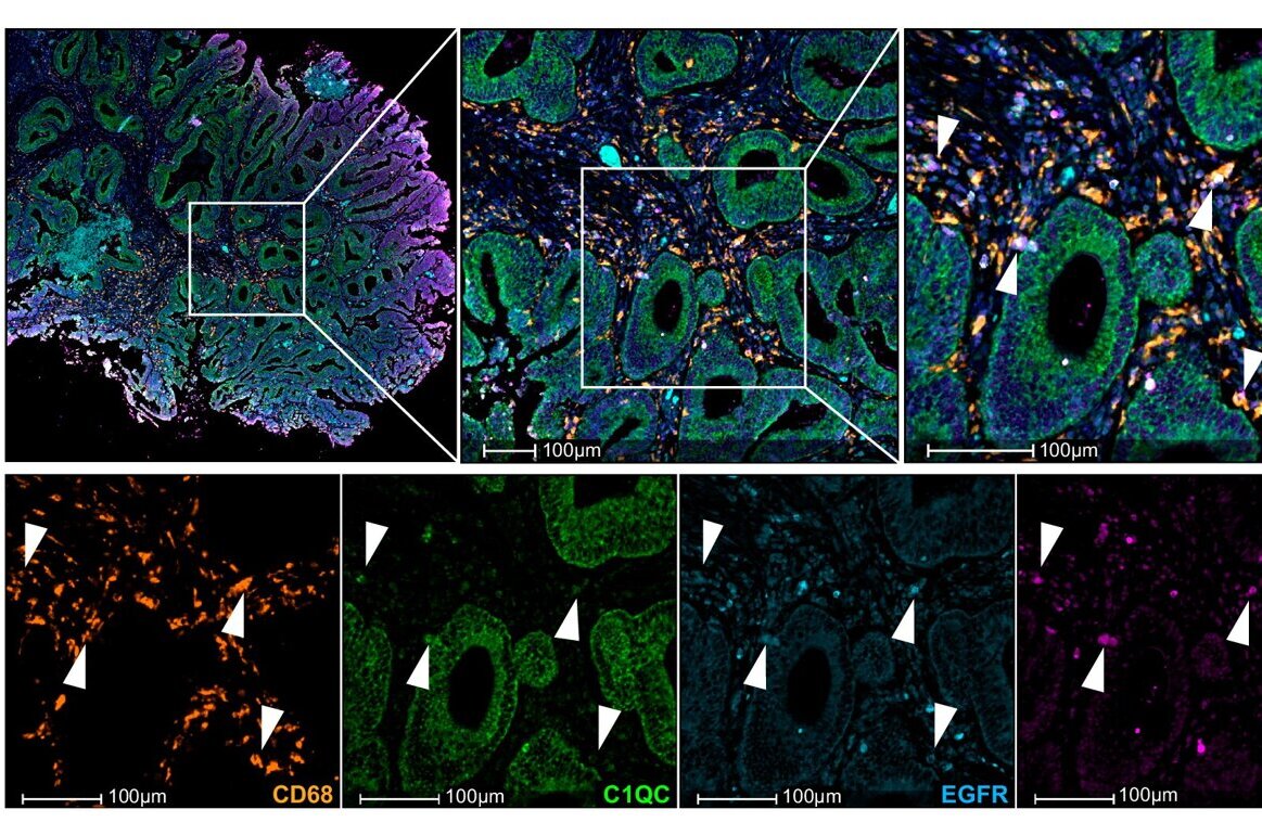 Colorectal cancer research reveals new mechanism in targeted therapy ...