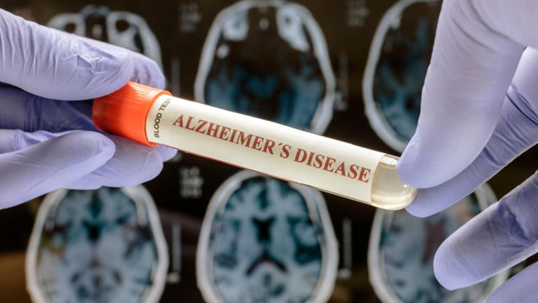 Alpha Cognition begins enrolment in RESOLVE Phase IV trial for Zunveyl