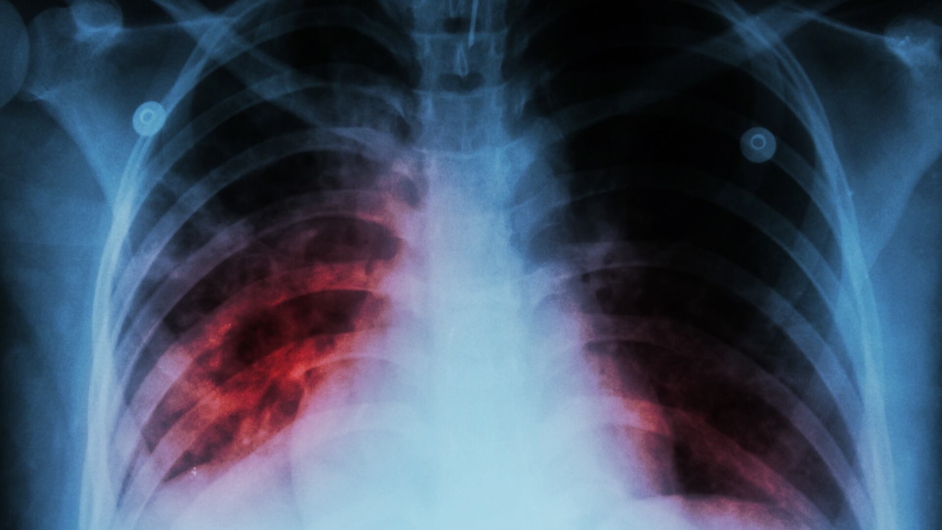 Tuberculosis case confirmed at Gaston County high school