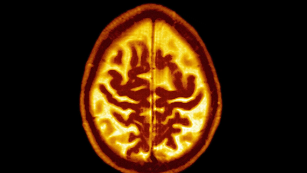 Dietary fats, ketosis, and brain health