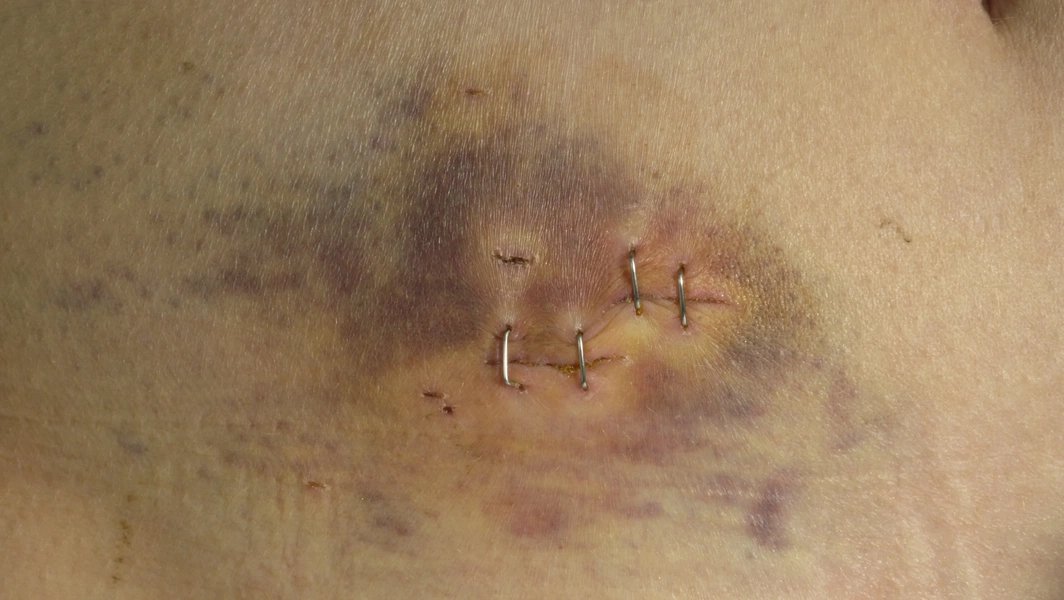 When bruising signals a serious health issue
