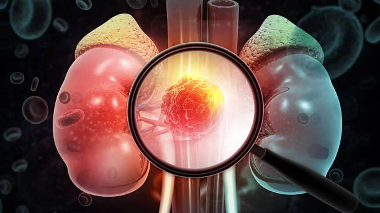 Kidney cancer is a silent killer: Doctors say early detection can be ...