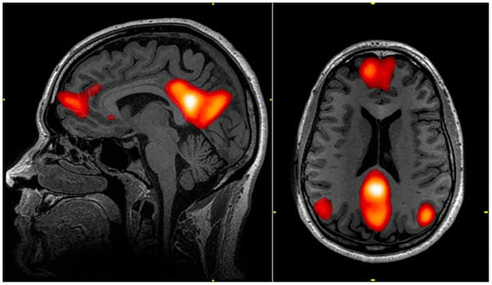 A common vitamin was linked to healthier brain networks in more than ...