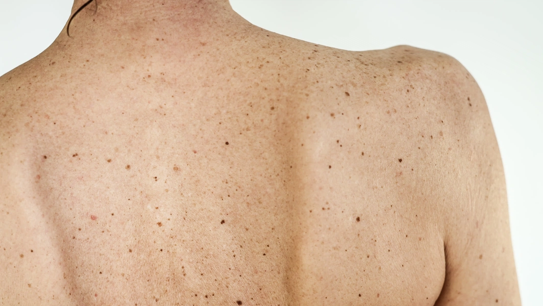 Treating and preventing sunspots on the face