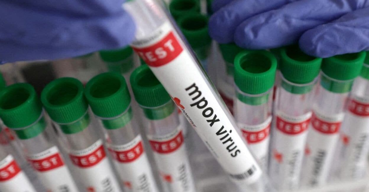 Suspected mpox case reported in Thiruvananthapuram; sample sent for testing