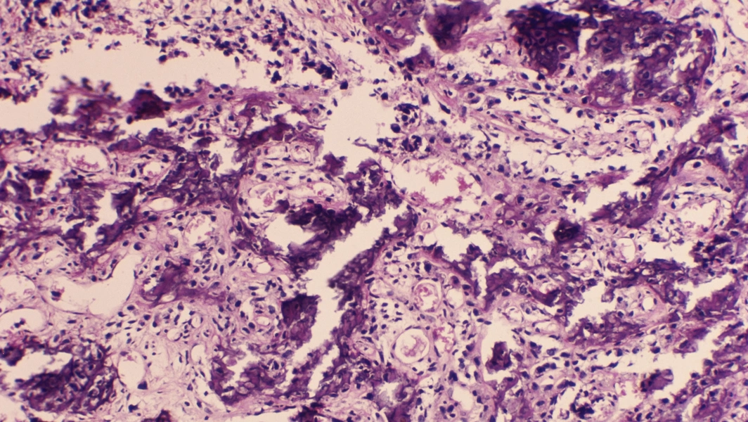 Understanding bone and blood cancers