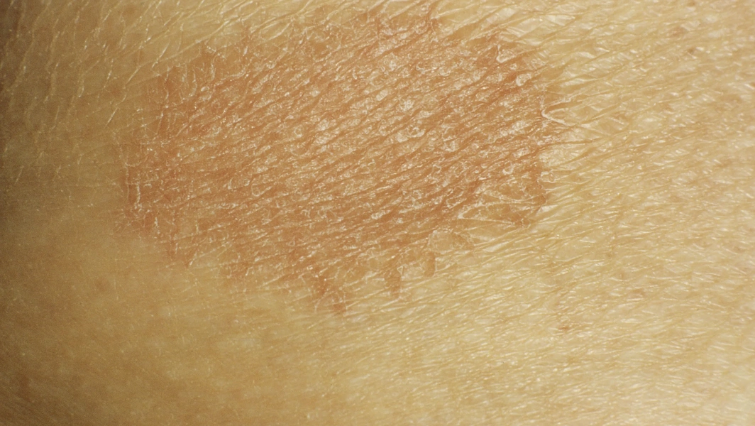 Recognizing the many faces of eczema