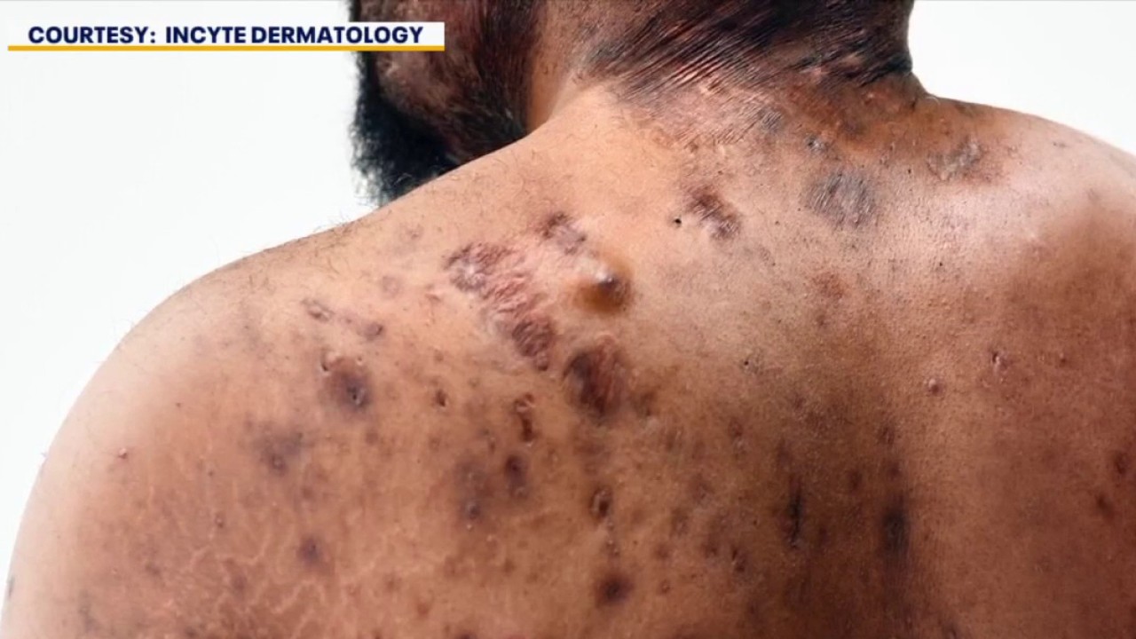 Hidradenitis suppurativa: Chronic skin disease info