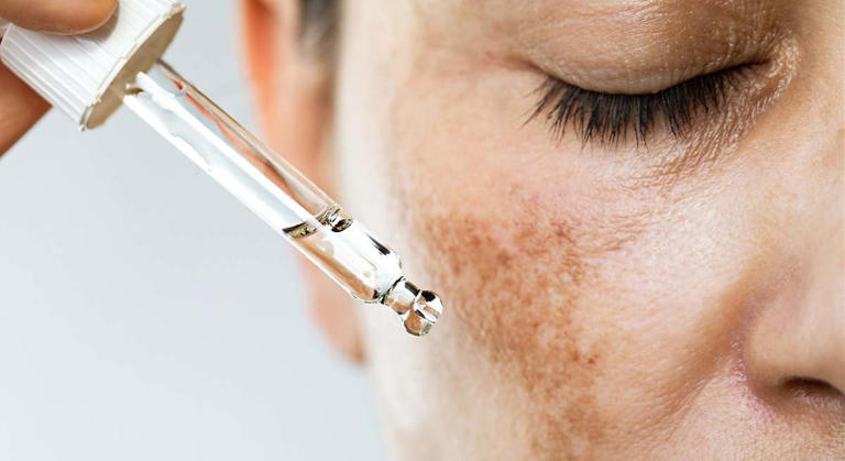Los dermatólogos coinciden: A partir del ahora, para mejorar el melasma ...