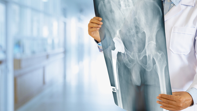 Things you should never do after having your hip replaced