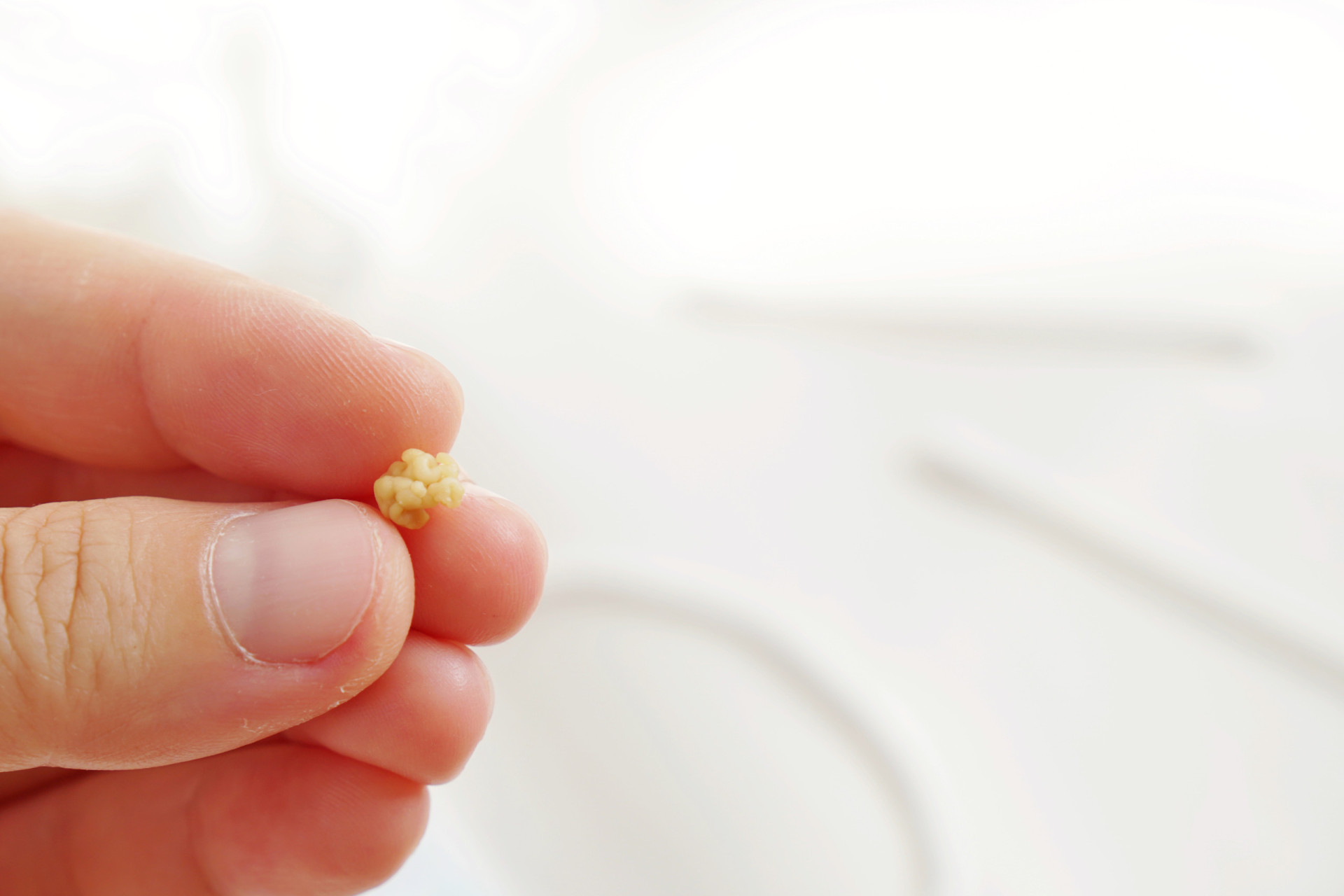 Why you might have tonsil stones and not even know it