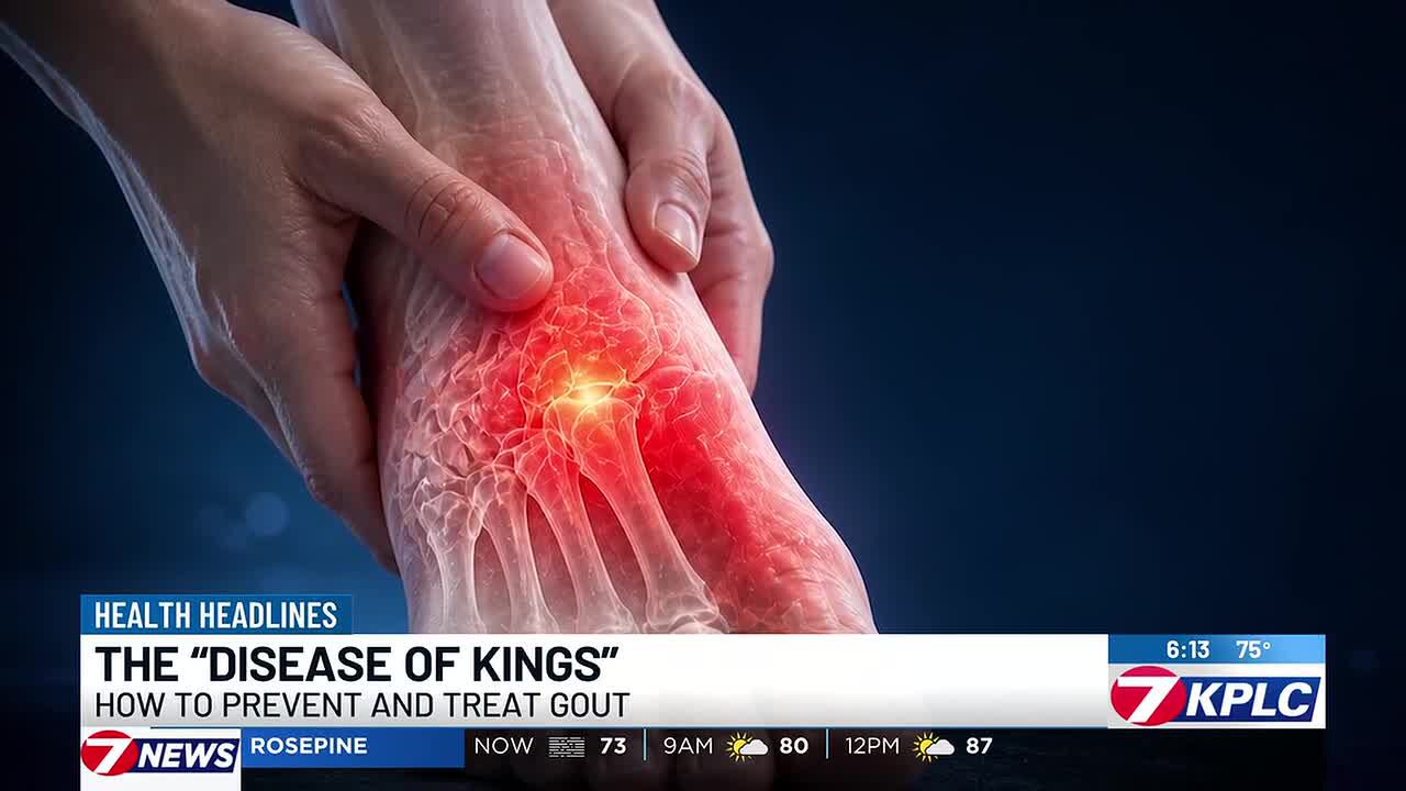 The disease of kings: How to prevent and treat gout