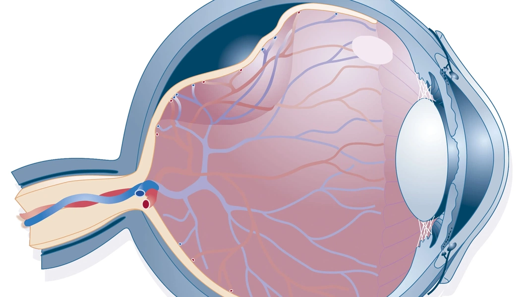 Surgeon's brush with blindness prompts urgent eye floater warning