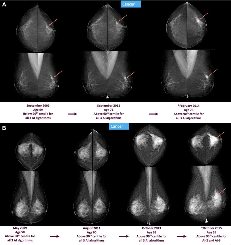 AI could provide early alert for breast cancer 6 years in advance