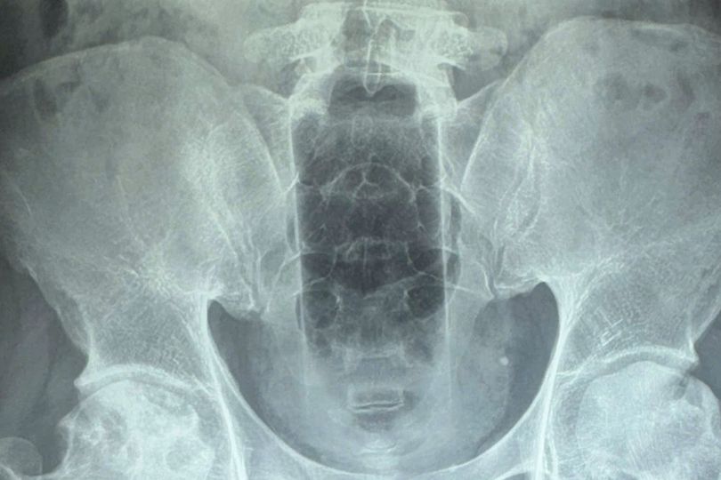 Doctors remove 20cm bottle from bloke's bum after he gets it stuck ...